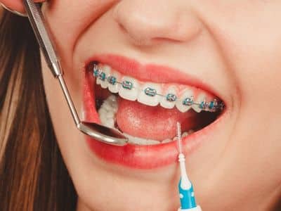 Comprehensive Guide on Braces - What You Need to Know - Pezoldt ...